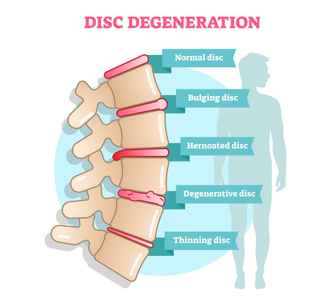 Bulging Discs, The Fix | Doctor Explains